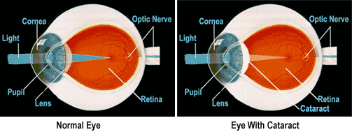 what is a cataract